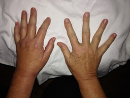 Jinny Farmer, Recovering from Hand-Shoulder-Complex Nerve Dystrophy ...