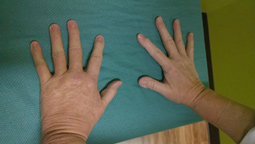 Jinny Farmer, Recovering from Hand-Shoulder-Complex Nerve Dystrophy ...